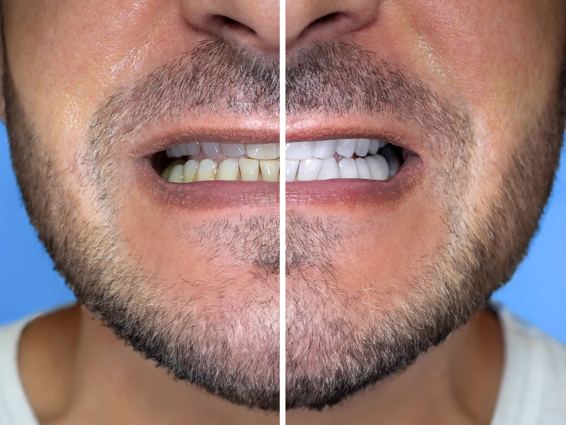 Professional Teeth Whitening | Innovative Smiles